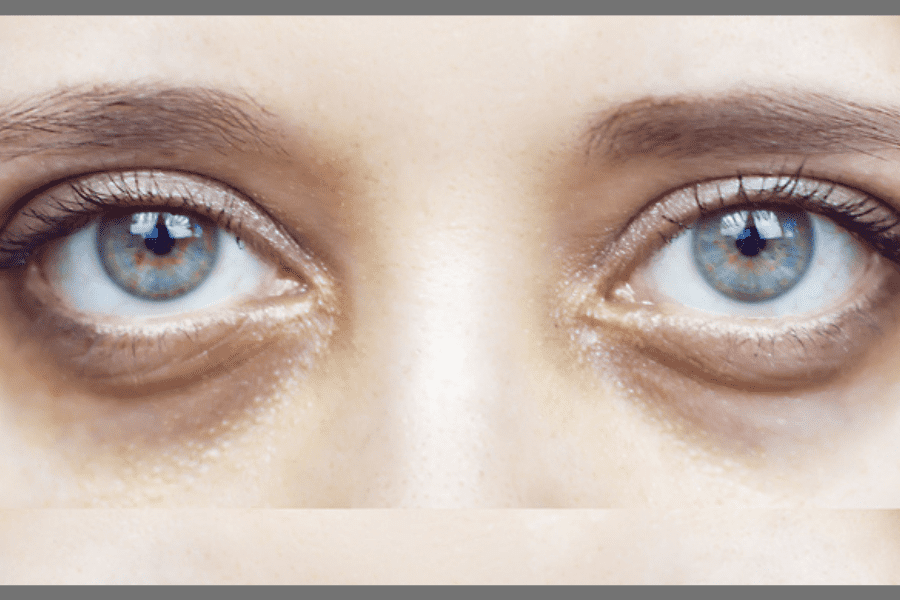 What To Do For Dark Circles Under Eyes (9 Natural Remedies For a Common ...